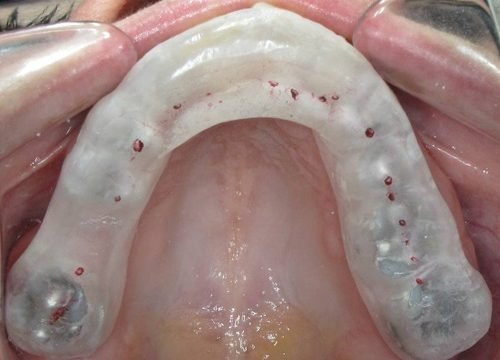 Guardas Oclusales – Denti Gom